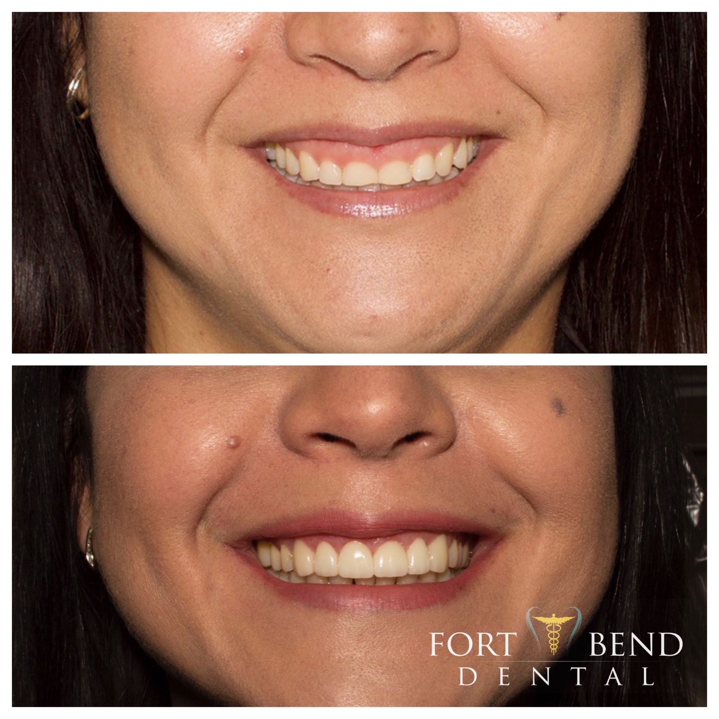 Gum Contouring Missouri City, Richmond, Rosenberg TX | Sugar Land, TX