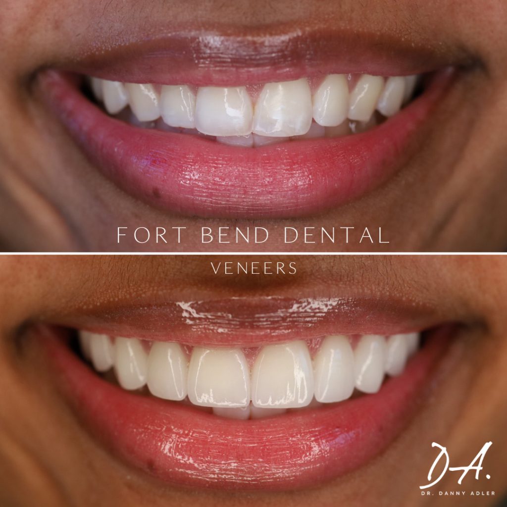 Porcelain Veneers Missouri City, TX | Dental Veneers Richmond, Rosenberg